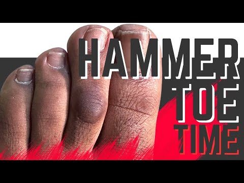 Hammer Toe Surgery
