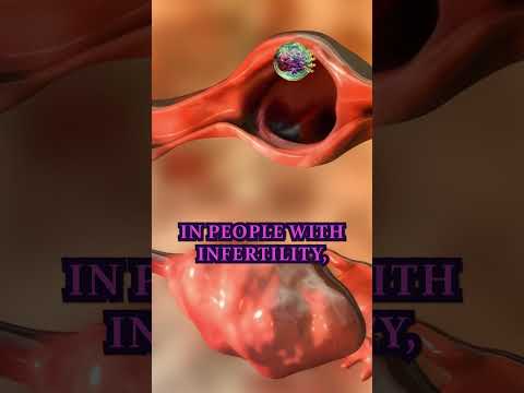 Uncommon Tests for Infertility: Chlamydia Antibodies & CRP