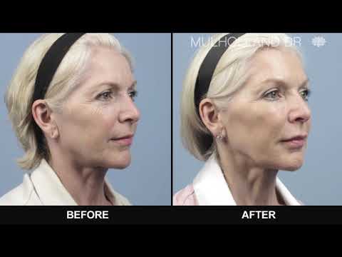 Botox Procedure with Dr. Mulholland | SpaMedica Toronto