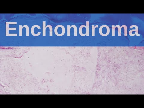 What are Enchondromas? - Pathology mini tutorial
