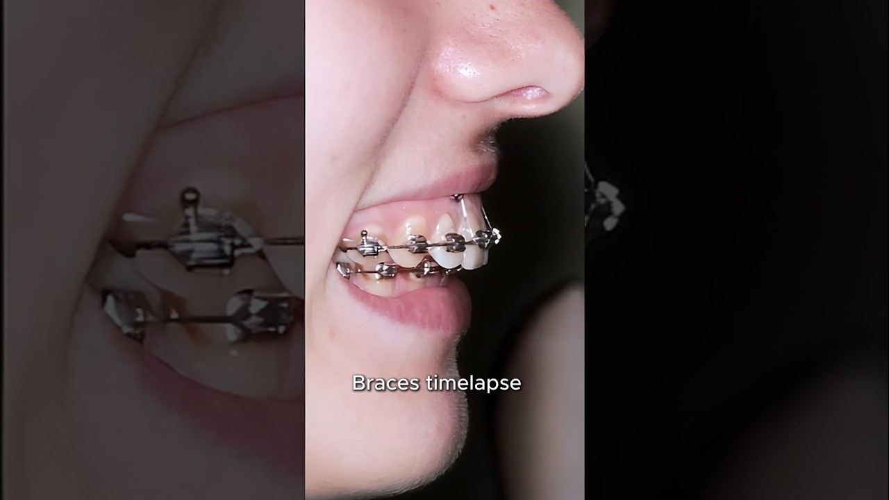 Braces fix gummy smile and overbite teeth #braces #orthodontist #dentist