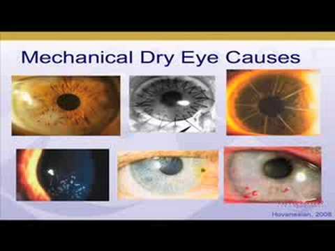 Dry Eye Treatment Part IV, John Hovanesian MD Harvard Eye