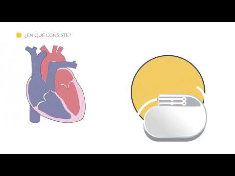 ADELE: IMPLANTACIÓN DE DESFIBRILADORES