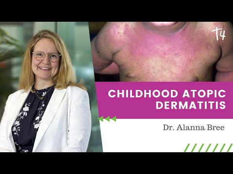 Childhood Atopic Dermatitis / October 2023 \ Tots to Teens Tidbits (T4)
