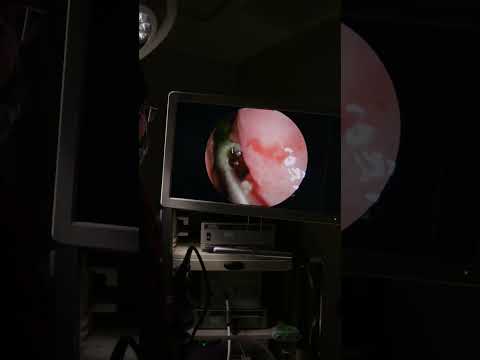 Removing a Sinus fungus ball from a patient’s nose! #nose #allergy #allergies #snot