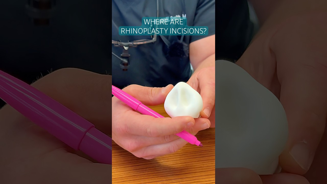 Where are Rhinoplasty incisions on the nose? 👃 #columbusohio #rhinoplasty #nose