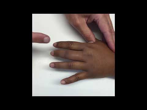 Proximal phalanx fracture
