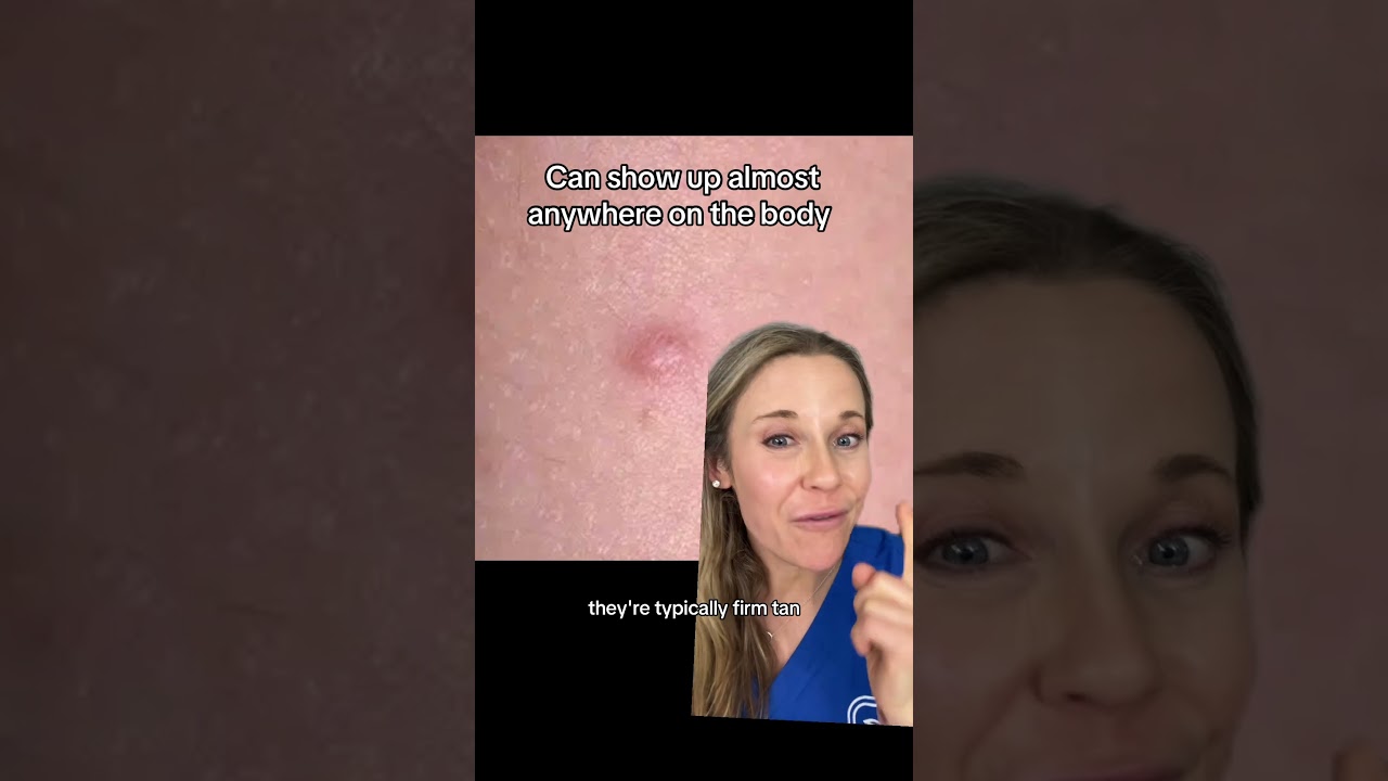 Teaching you to be a dermatologist one video at a time: part 1 Dermatofibroma. #shorts #dermatology