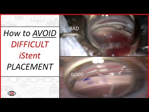 How to Avoid Difficult iStent Trabecular Micro Bypass Placement