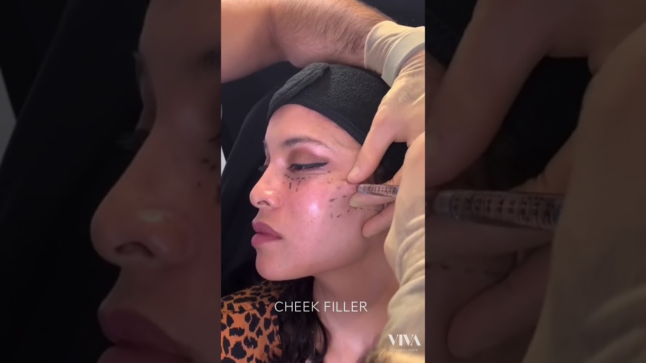Gorgeous Cheek Filler #dermalfillers #fillers #cheekfiller #cosmetics #skincare #lipfiller