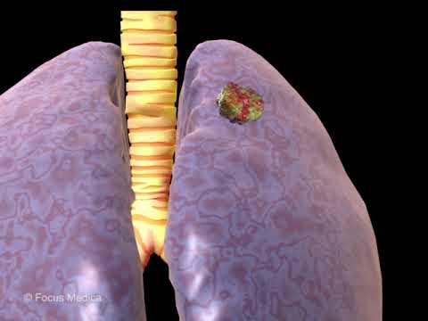 Superior Sulcus Tumors-Oncology
