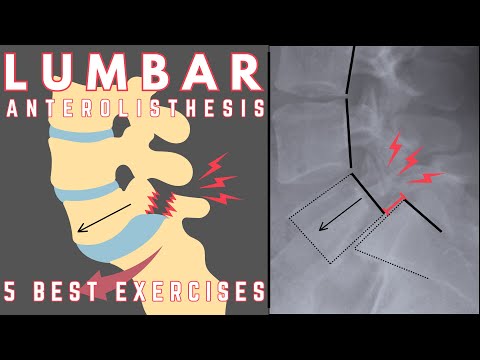Best Exercises for Lumbar Anterolisthesis | Relieve Lower Back Pain | Dr. Jon Saunders