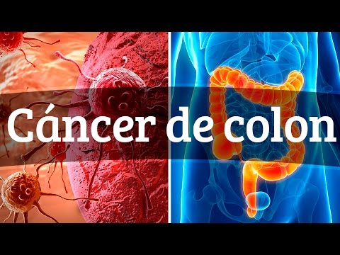 Cáncer de colon | Cirugía Hellín