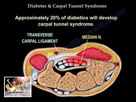 Diabetes & Carpal Tunnel Syndrome - Everything You Need To Know - Dr. Nabil Ebraheim