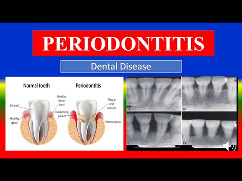 PERIODONTITIS - Definition, types, causes, pathophysiology, symptoms , diagnoses , medicine