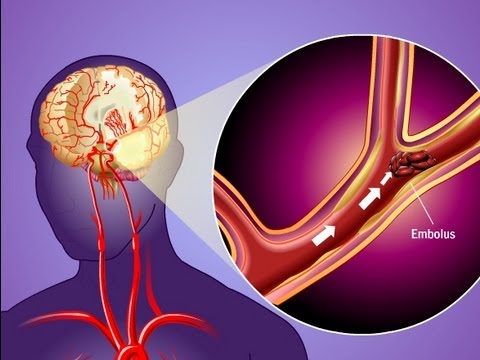 Stroke Prevention & Transient Ischemic Attack (TIA)