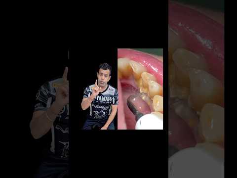 DENTIST Reveals SECRET to Cleaning Teeth with Ultrasonic Scaler