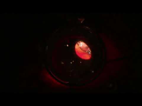Inverted ILM flap for Macular hole surgery- FULL surgery