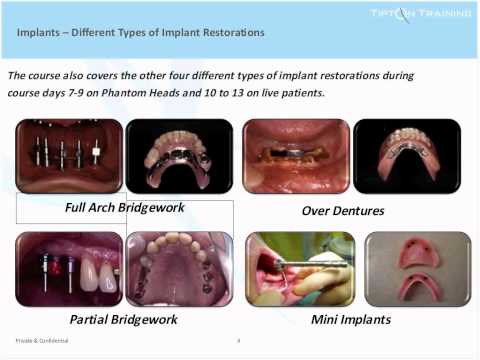 Tipton Training- One Year Implant Course Overview