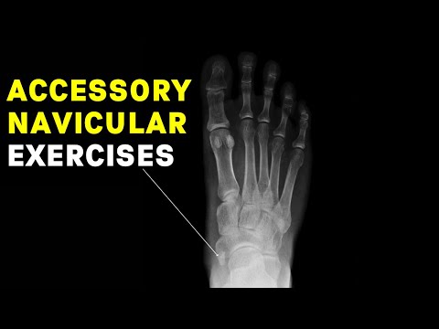 Accessory Navicular Syndrome Exercises by a Foot Specialist