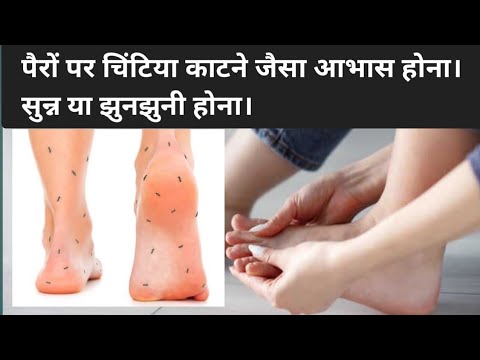 Tingling, Numbness or Formication पैरो पर चीटिया काटने जैसा आभास होना | झुनझुनी या सुन्न पन्न होना।