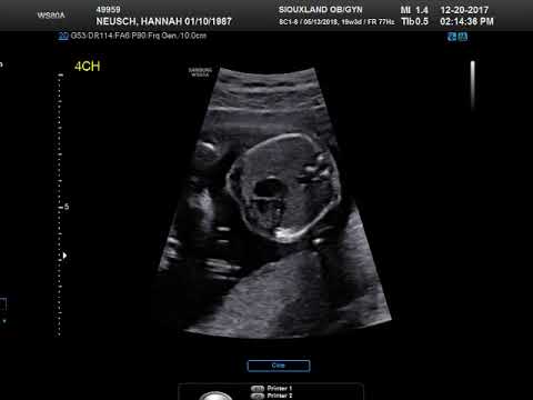 20 Week Ultrasound with EIF (calcification in heart)