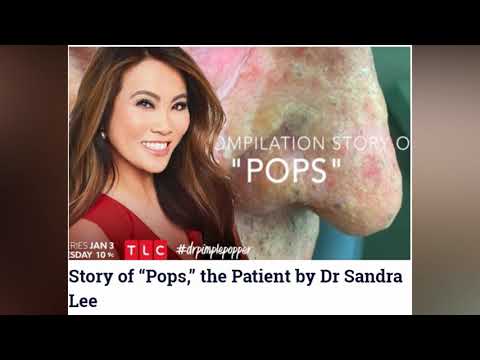 Mr. Popper's Weekly Blackhead Updates; Blackhead King
