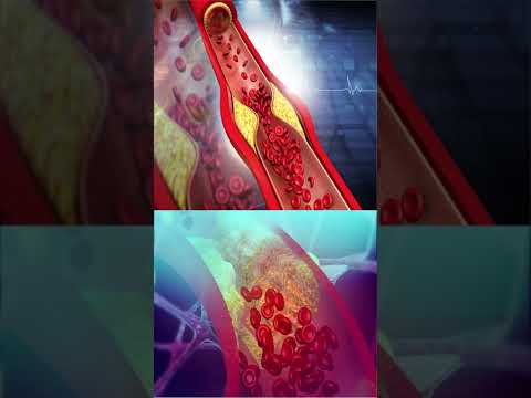 एंजियोप्लास्टी स्टेंट लगाने के बाद जीवन नार्मल रहता है ? CAN YOU LIVE A NORMAL LIFE WITH HEART STENT
