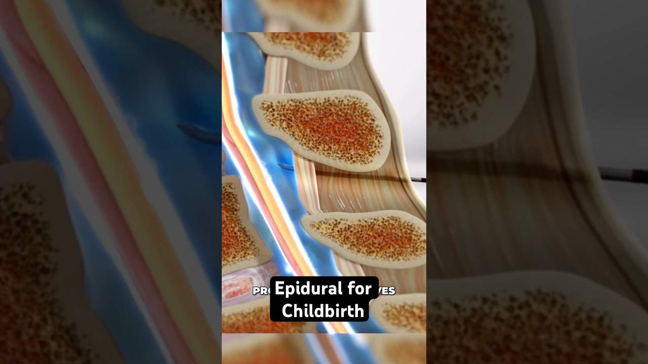 Epidural for Childbirth (3D Animation)
