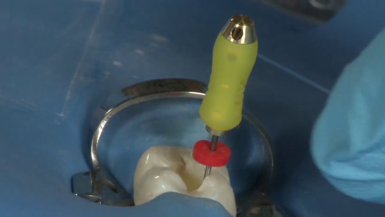 Ultradent's Irrigation Protocol System for Root Canals