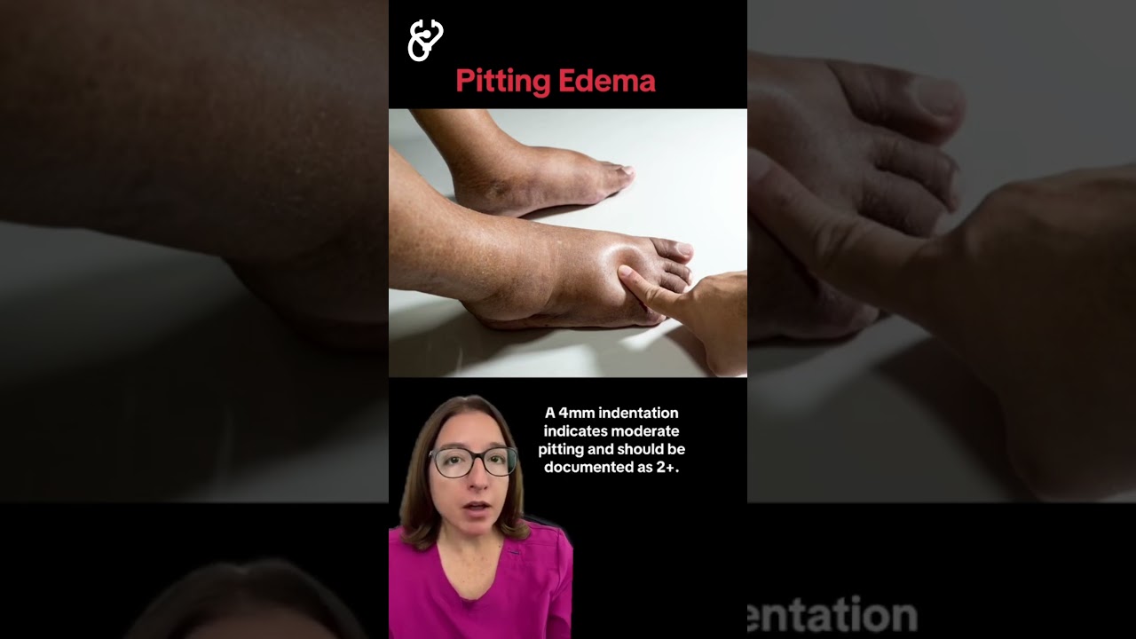 Pitting Edema: Health Assessment SHORT | @LevelUpRN