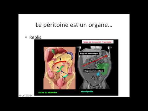 Tumeurs du péritoine: bases anatomiques – Chirurgie Oncologique