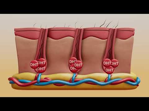 How Does Laser Hair Therapy Regrow Your Hair?