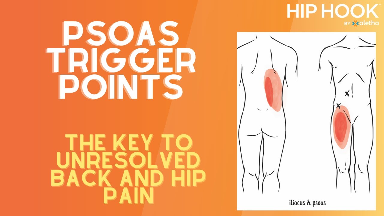 Psoas trigger points