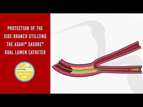 Side Branch Protection: Dual-Lumen Tutorial