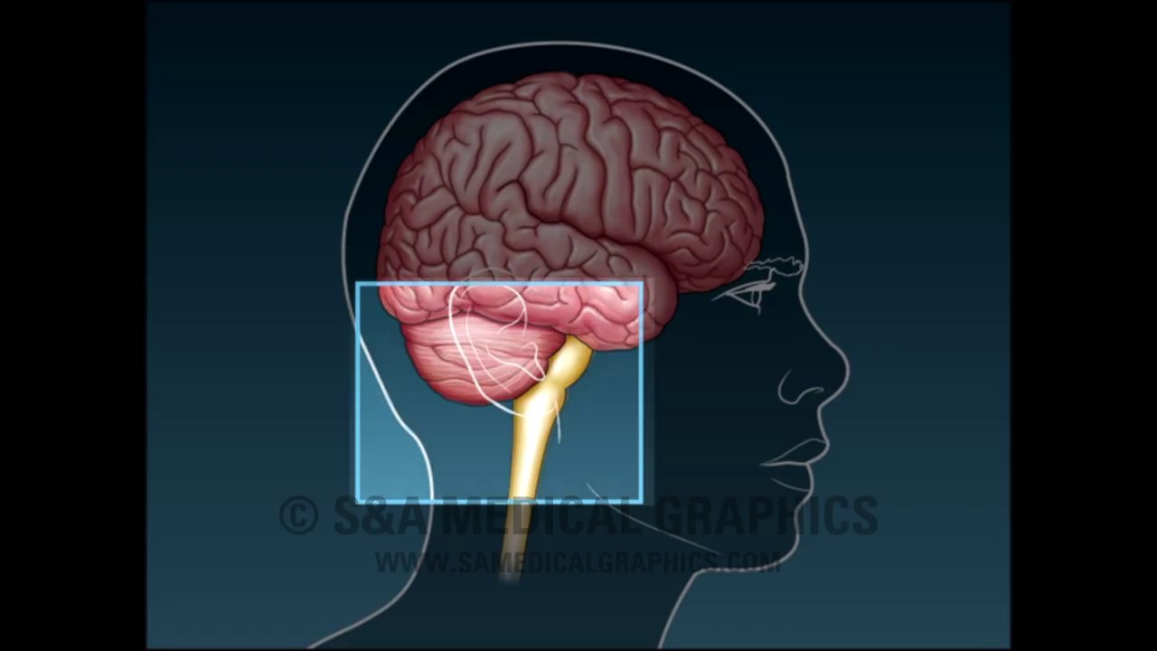 Meningitis and Stroke Animation