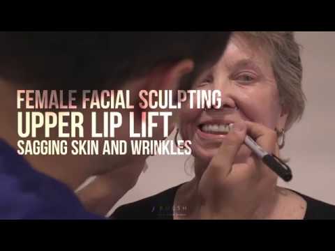 Lip Lift | Sagging Skin and Wrinkles | Los Angeles | Dr. Ardesh