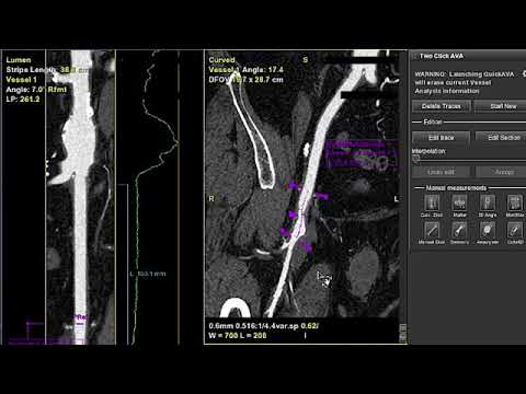 AutoBone Vessel IQ 3 Stenosis measurements Summary table