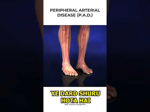 Claudication In Legs Symptoms | Claudication | Leg Pain | Dr. Gaurav Gangwani