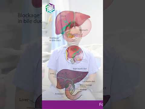 How Does PTBD Differ from ERCP in Accessing Bile Ducts? | Dr praveen Kammar, Mumbai