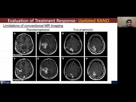 Brain Tumor Webinar