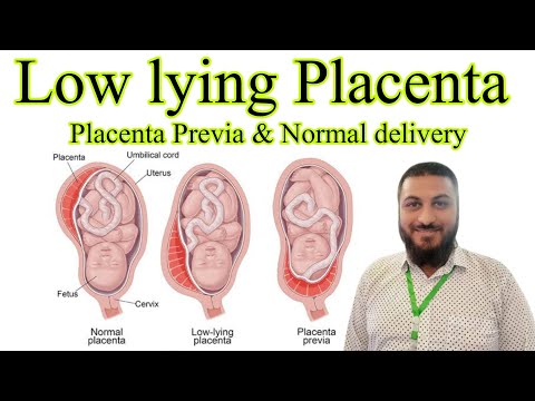 Placenta low lying Previa Normal delivery #ultrasound @DrQaziFahimShezad