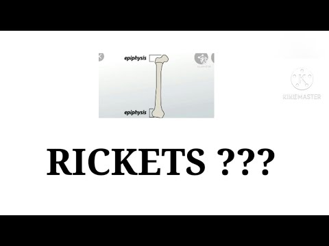 Rickets | general clinical | Basic concept building