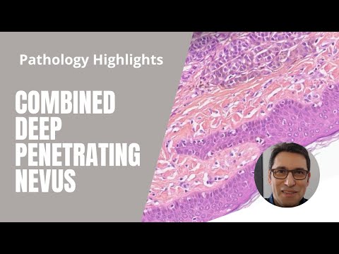Pathology Highlights : Combined deep penetrating nevus