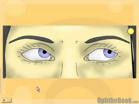 Cranial Nerve 6 palsy