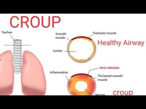 Croup (Laryngotracheobronchitis)| Croup Cough| Croup Cough Sound| Croup Pediatric|What causes croup|
