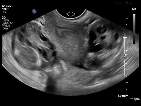 Bilateral salpingitis ultrasound