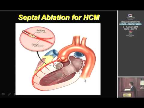 Criteria for Major Intervention in HCM