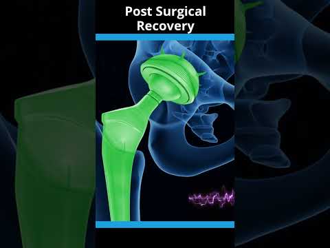 This is What Happens After Total Hip Replacement Surgery