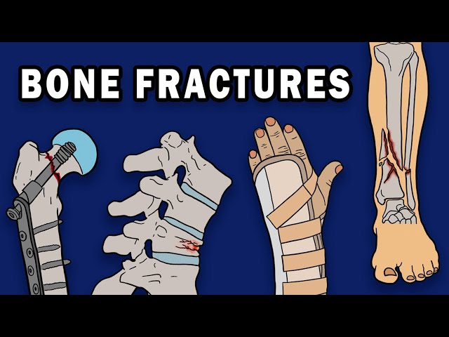 Understanding Bone Fractures: Types, Causes, and Complications | Galaxy